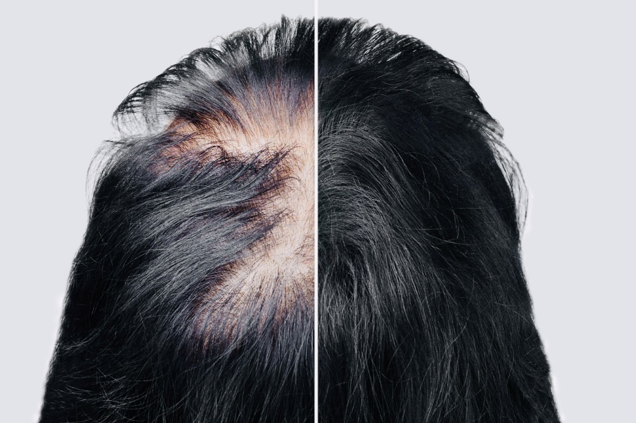 Top 10 Benefits of Scalp Ink Micropigmentation for Hair Loss - Skalp ...