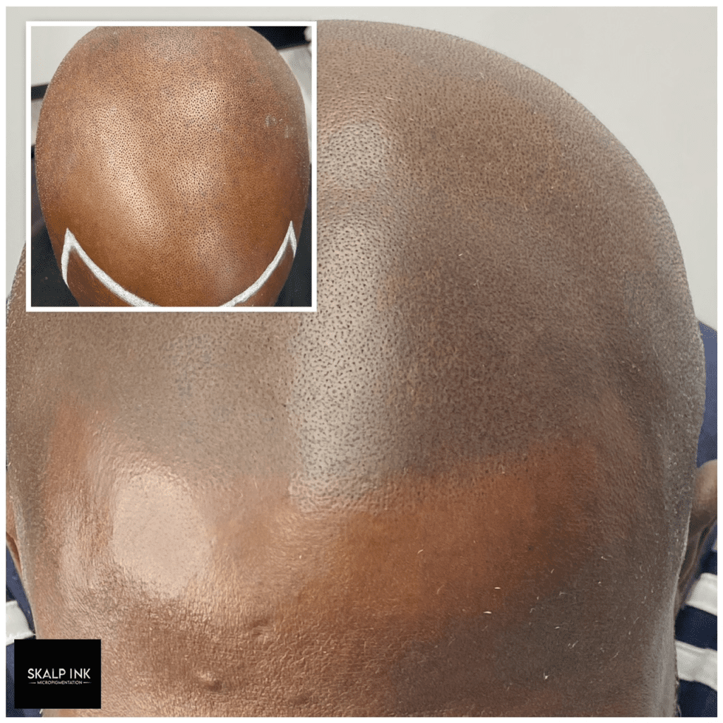Is Scalp Ink Micropigmentation Right for You? A Comprehensive Checklist ...