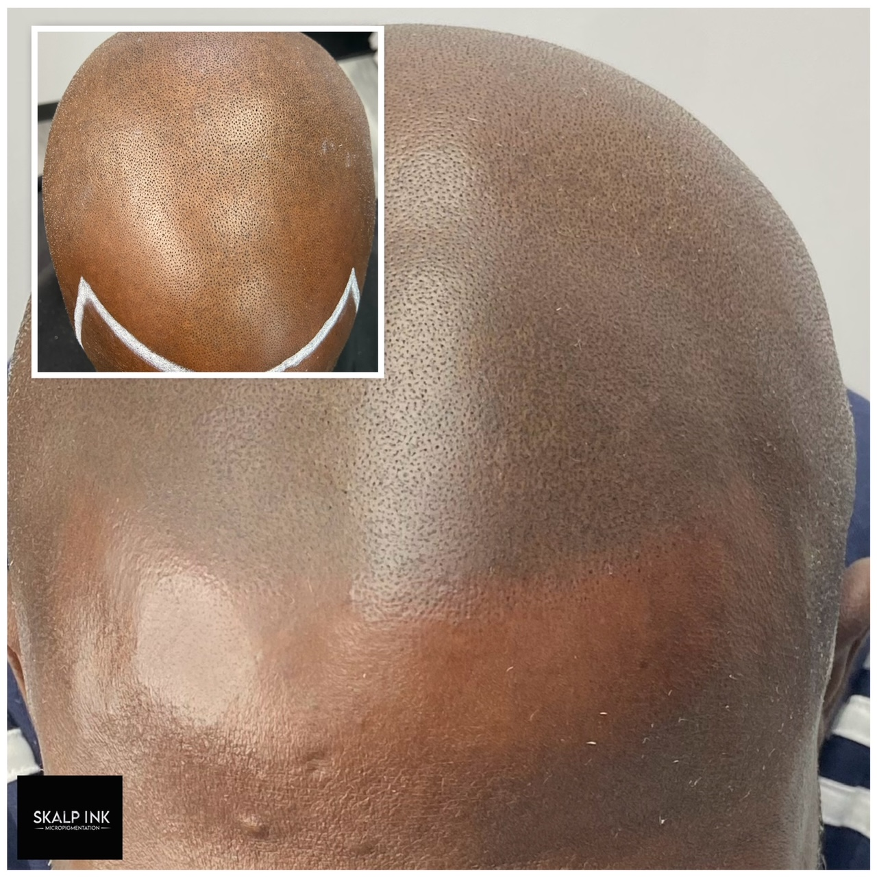 Is Scalp Ink Micropigmentation Right for You? A Comprehensive Checklist ...