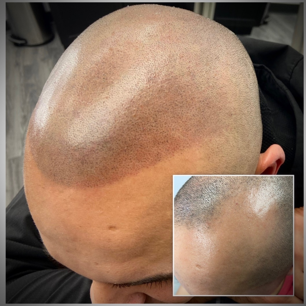 Scalp Ink Micropigmentation vs. Hair Transplants: Which is Better ...